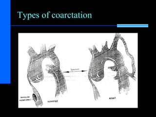 Coarctation of aorta | PPTX