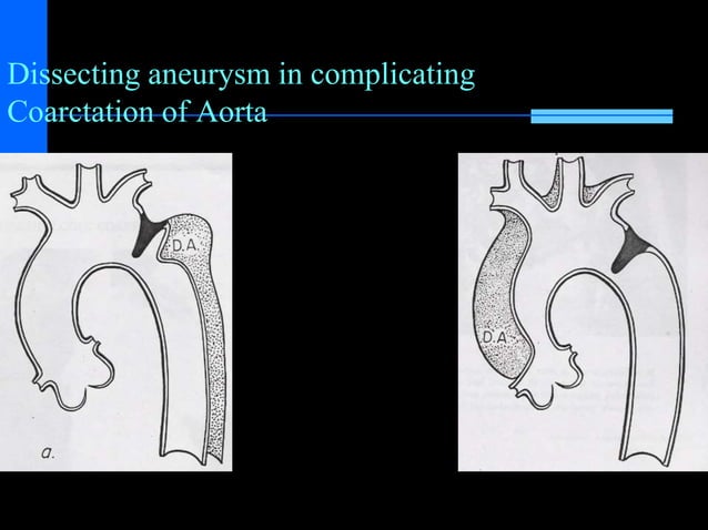 Coarctation of aorta | PPTX