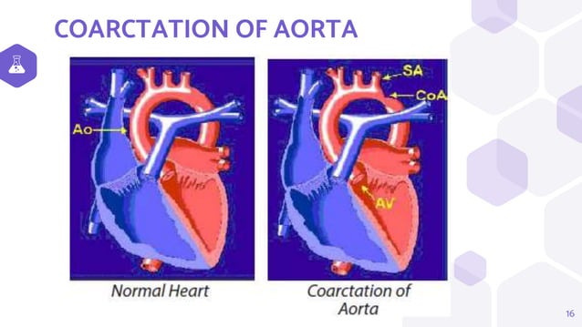 COARCTATION OF AORTA .pptx