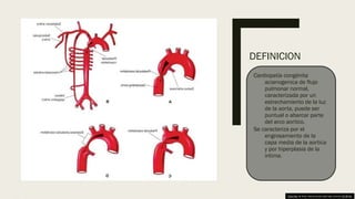 coartacion aortica pediatria diagnostico pptx | PPTX