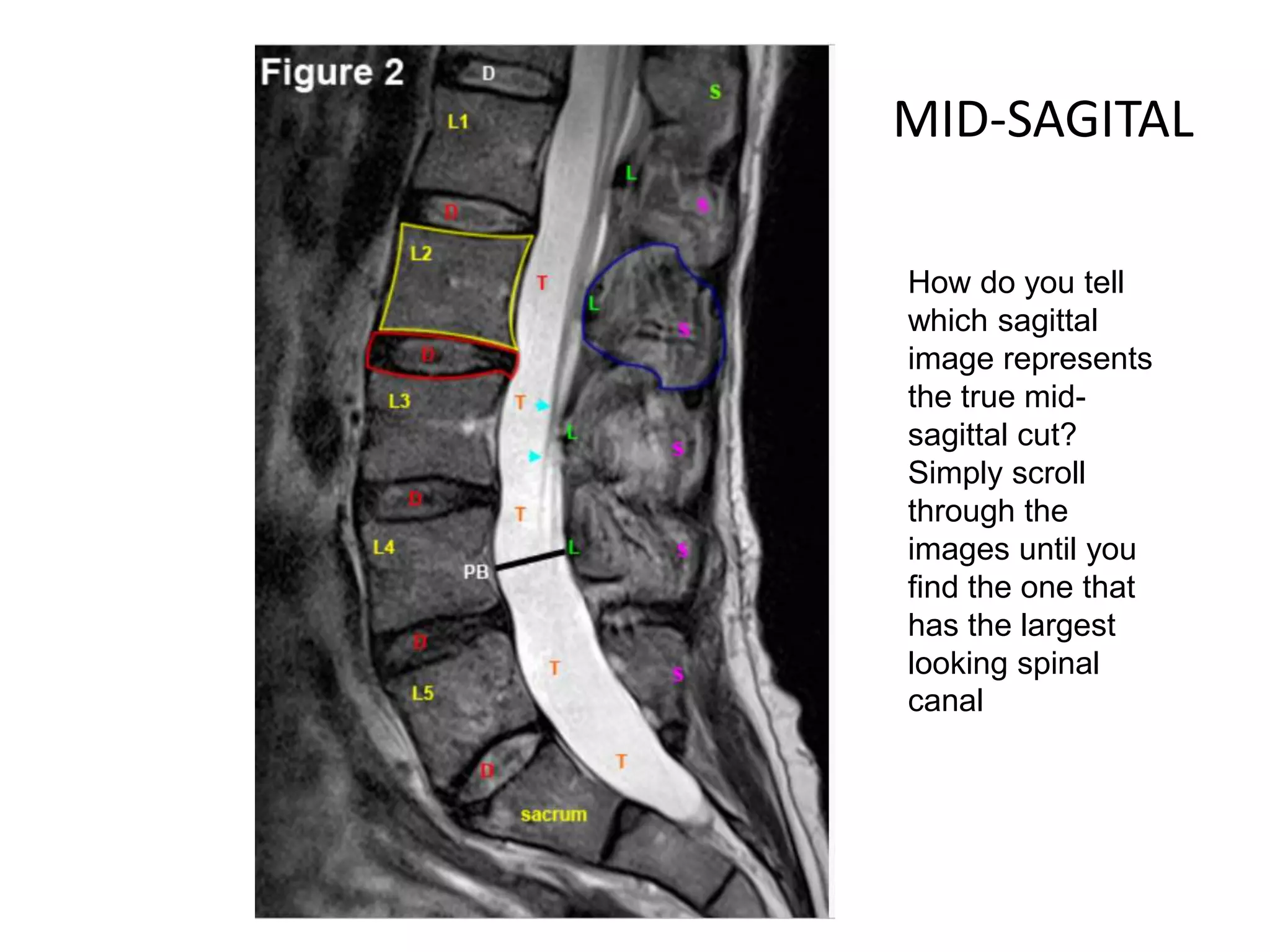 how to read spine mri | PPTX