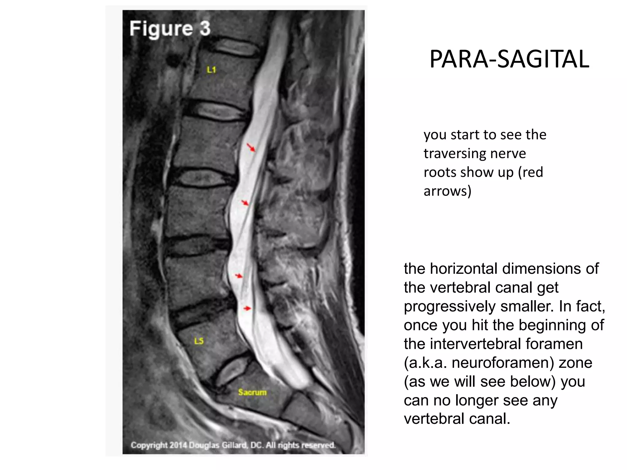 how to read spine mri | PPTX