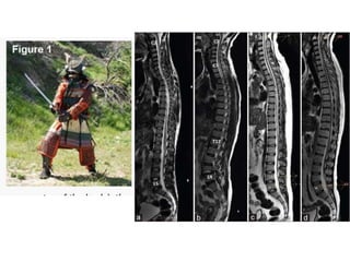how to read spine mri | PPTX