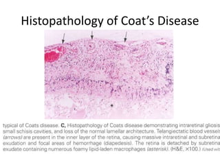 Coats dse | PPTX