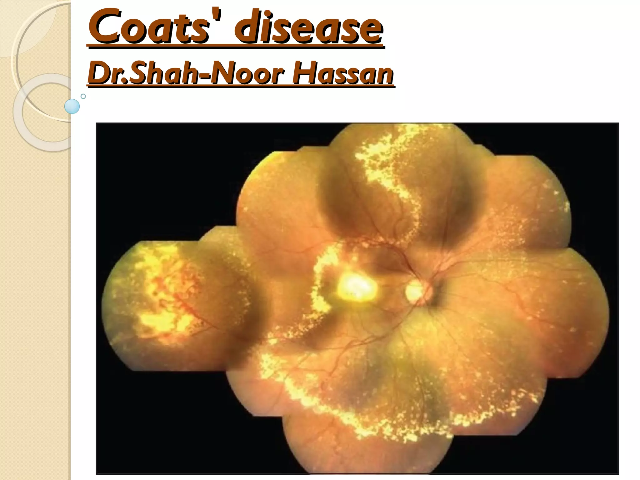 Coats' Disease | PPT