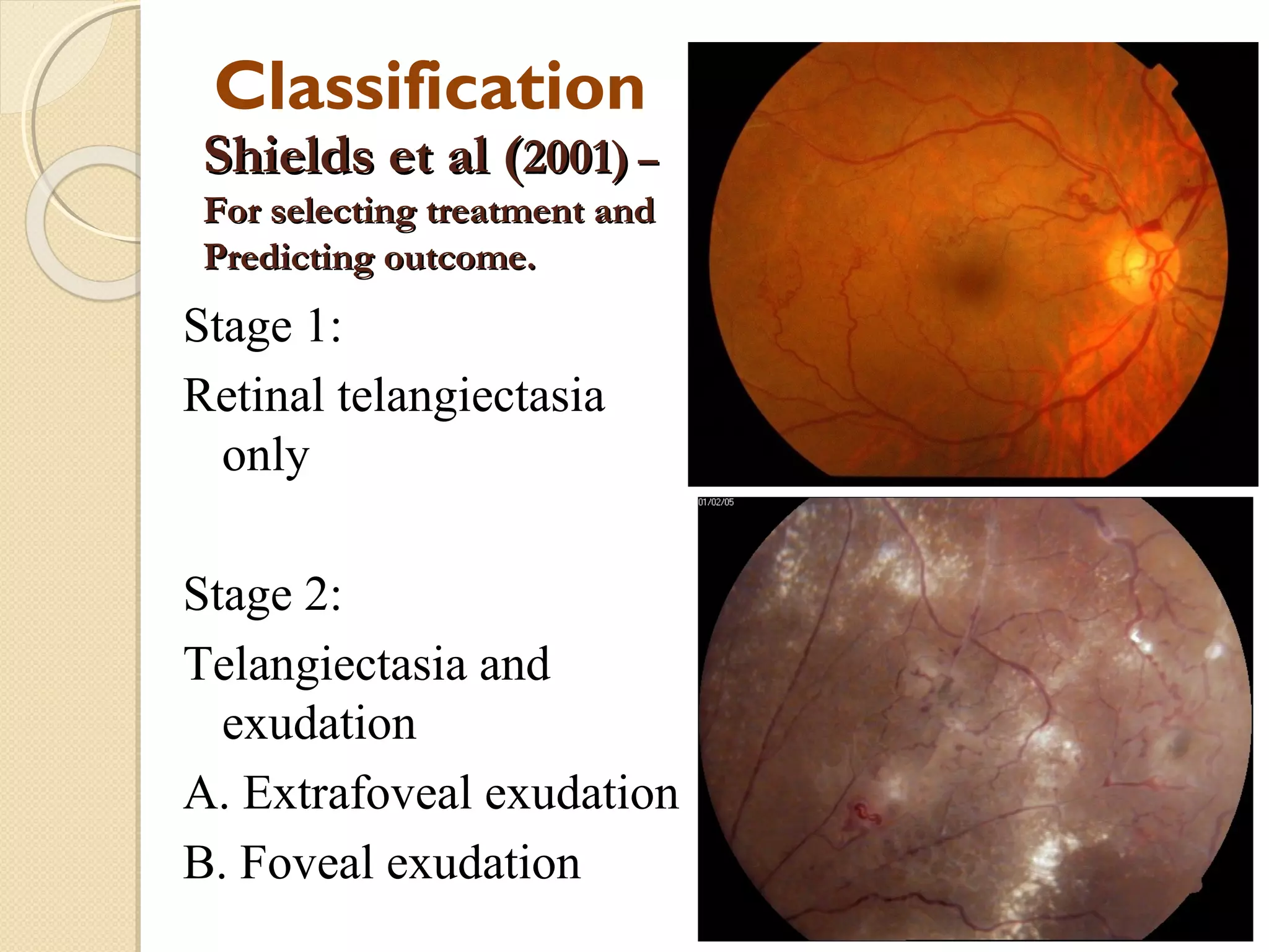 Coats' Disease | PPT
