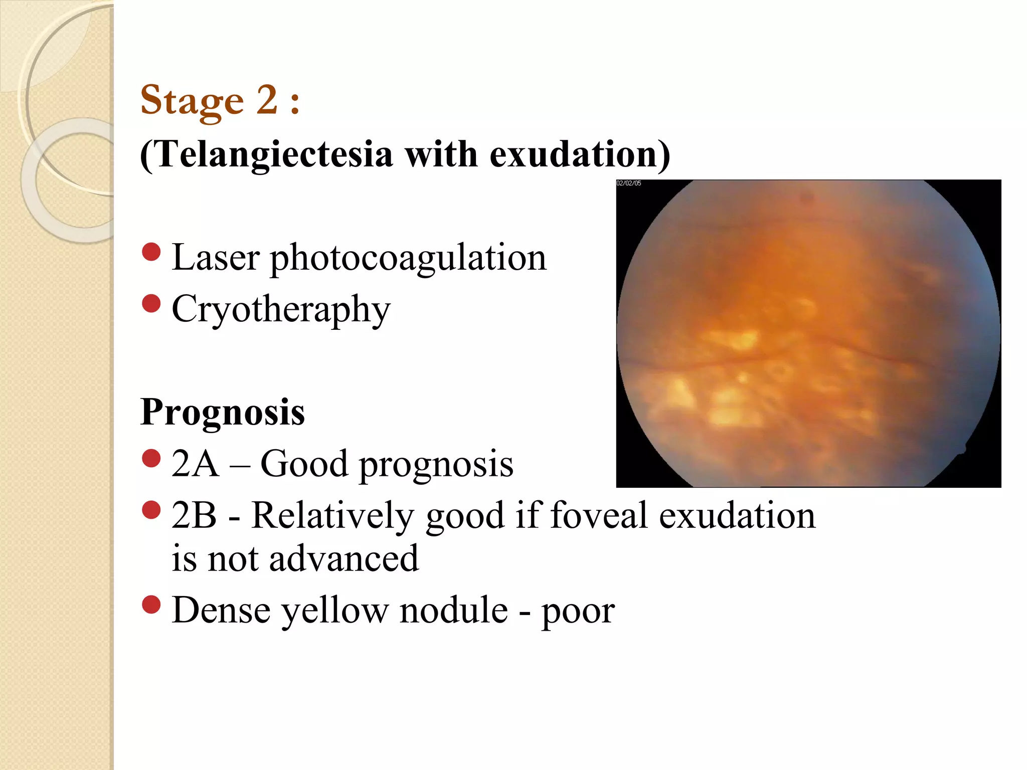Coats' Disease | PPT
