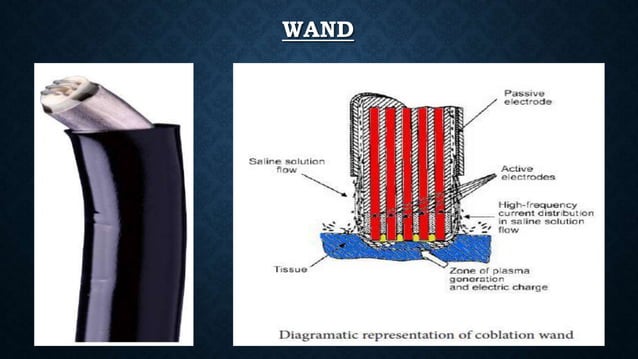 Coblation in ent | PPTX