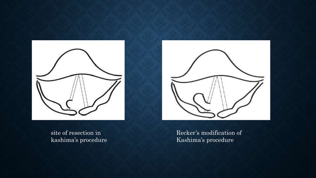 Coblation in ent | PPTX