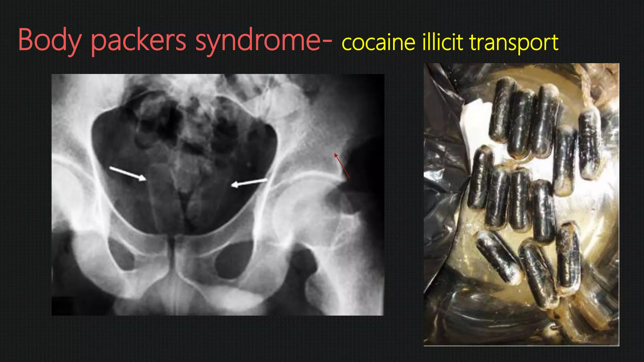 Cocaine a delirient in forensic perspective | PPTX