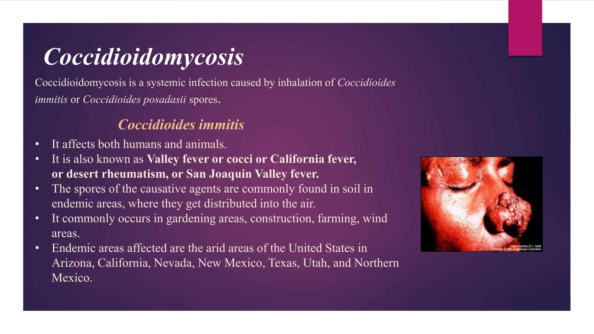 Understanding Coccidioidomycosis: Causes, Symptoms, and Treatment. | PPTX