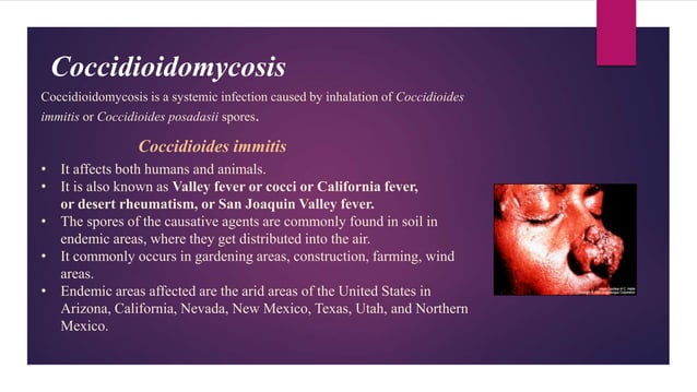 Understanding Coccidioidomycosis: Causes, Symptoms, and Treatment. | PPTX
