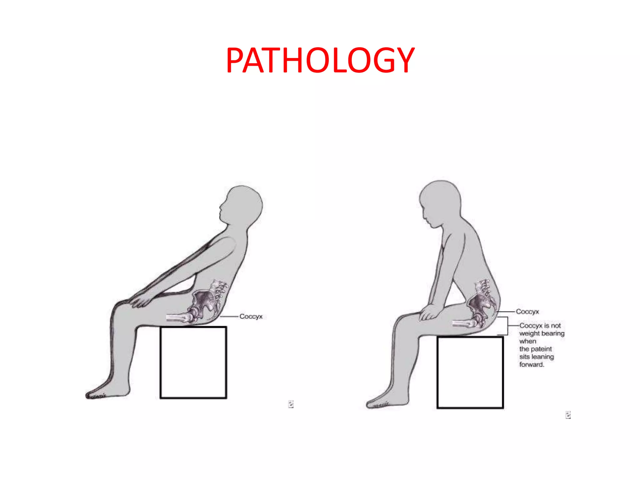 Coccydynia | PPTX