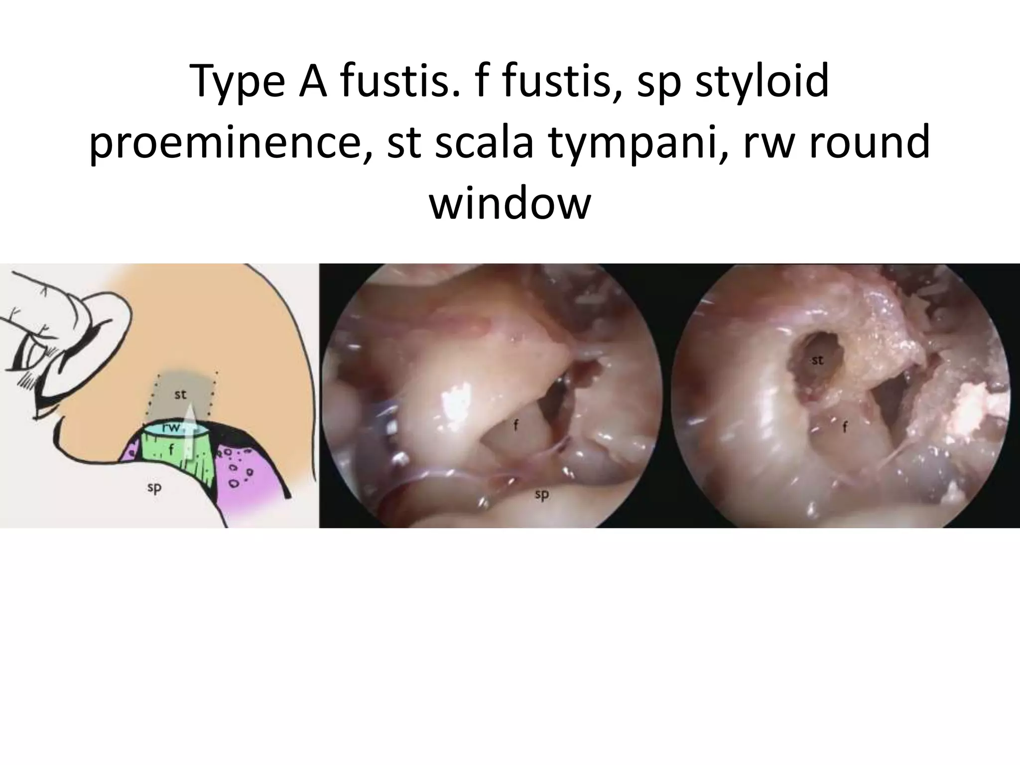 Cochlea cadaver dissection - part 1 | PPTX