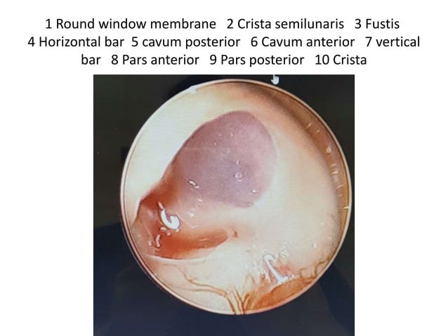 Cochlea cadaver dissection - part 1 | PPT