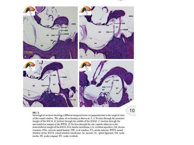 Cochlea cadaver dissection - part 1 | PPT