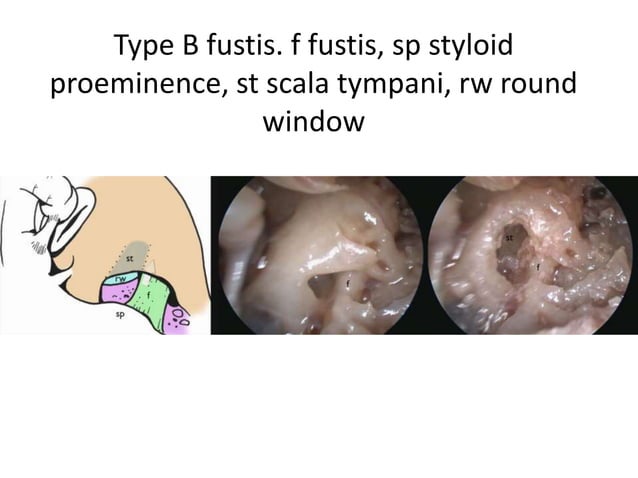 Cochlea cadaver dissection - part 1 | PPT