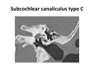 Cochlea cadaver dissection - part 1 | PPTX