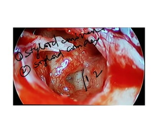 Cochlea cadaver dissection - part 1 | PPTX