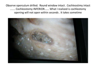 Cochlea cadaver dissection - part 1 | PPTX