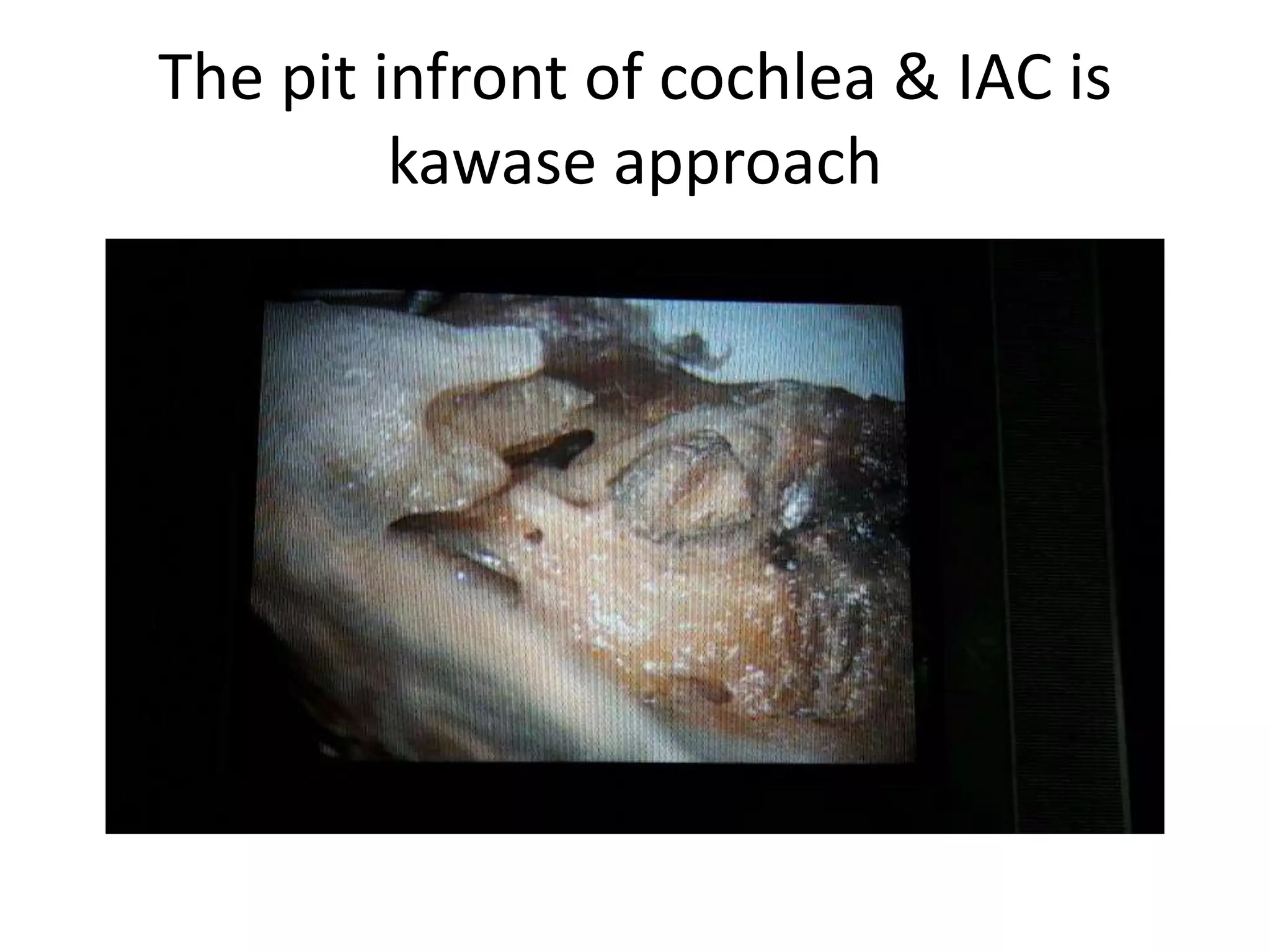 Cochlea cadaver dissection - part 2 | PPTX