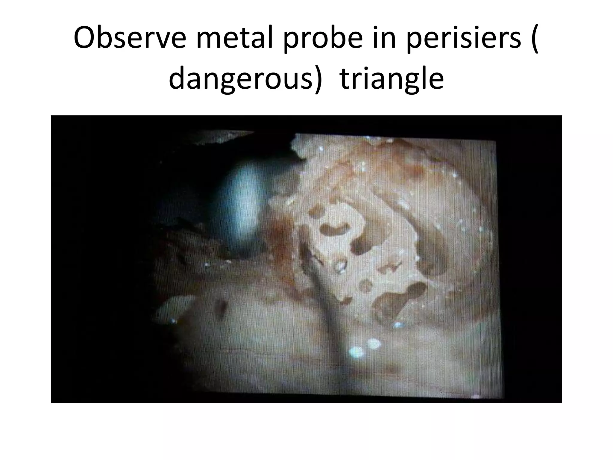Cochlea cadaver dissection - part 2 | PPTX