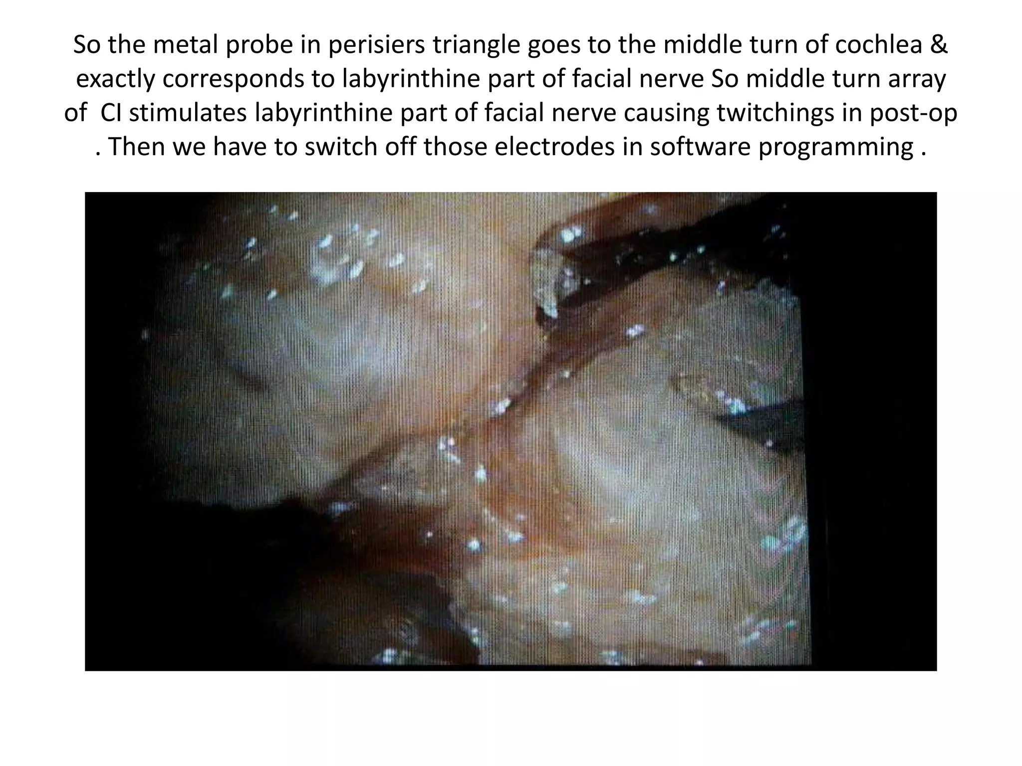 Cochlea cadaver dissection - part 2 | PPTX