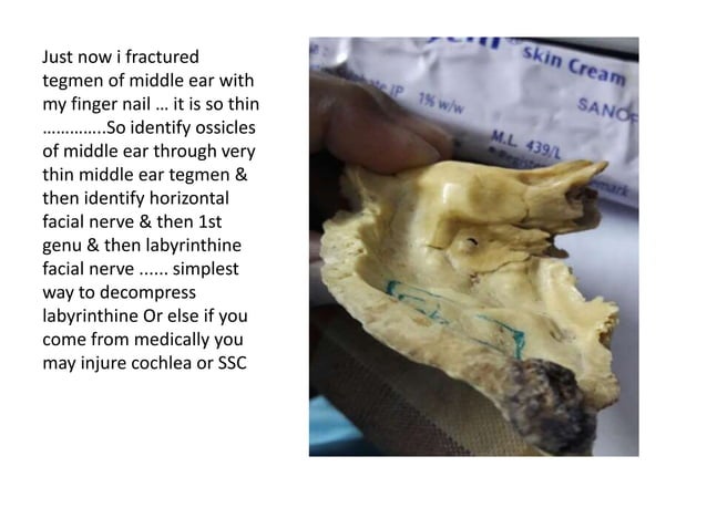 Cochlea cadaver dissection - part 2 | PPT