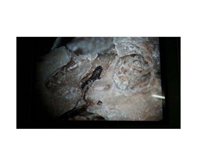 Cochlea cadaver dissection - part 2 | PPT