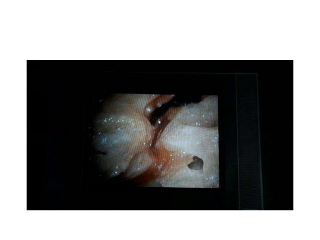 Cochlea cadaver dissection - part 2 | PPT