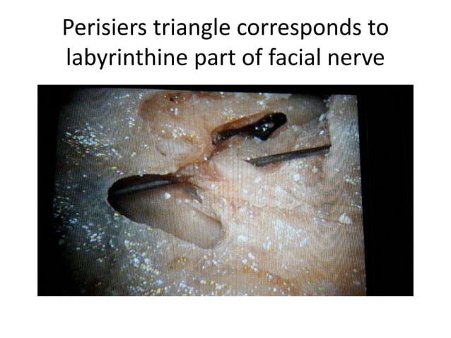 Cochlea cadaver dissection - part 2 | PPT