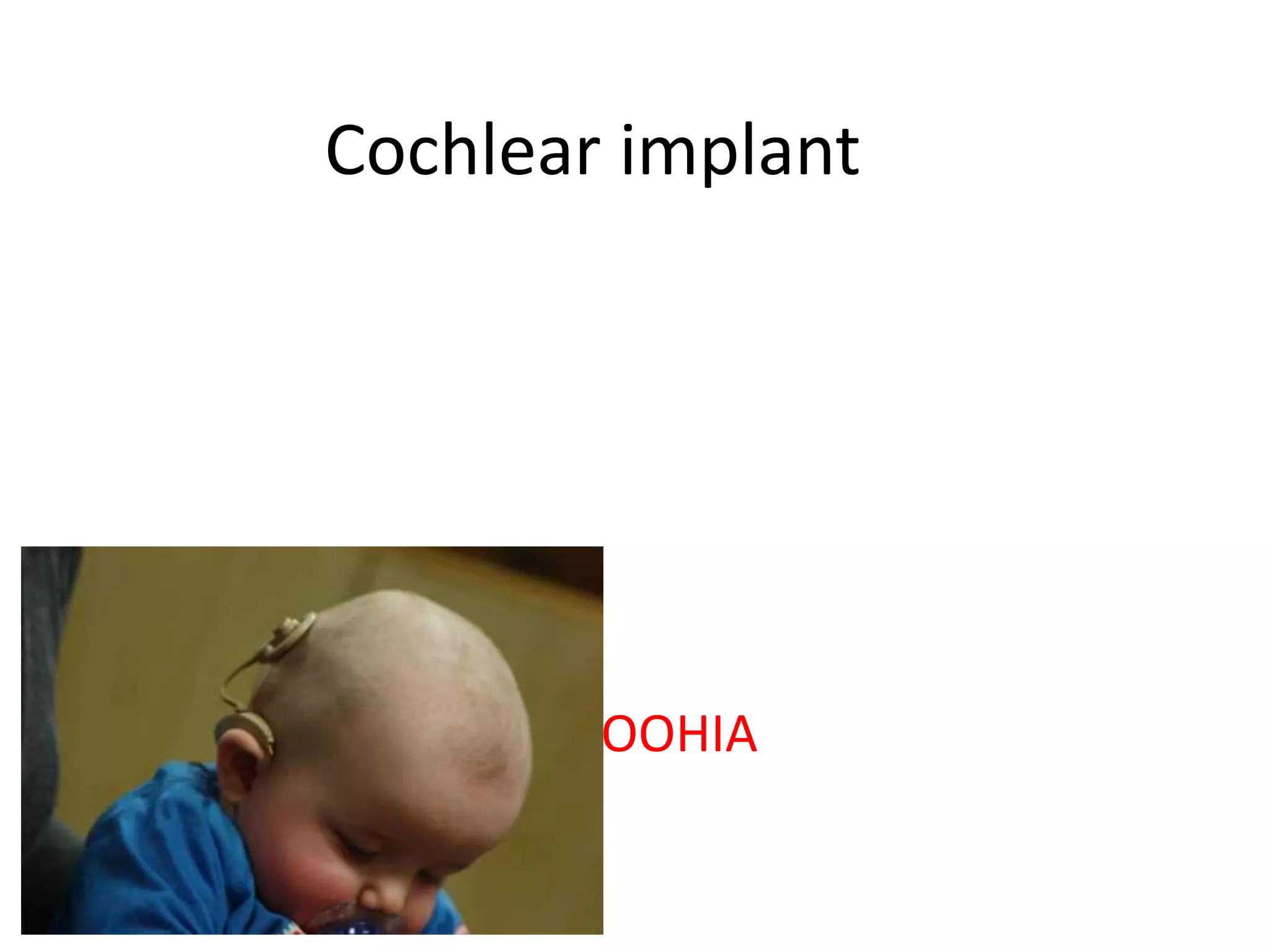 Cochlear implantation | PPTX
