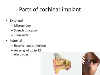 COCHLEAR IMPLANTATION over view | PPTX