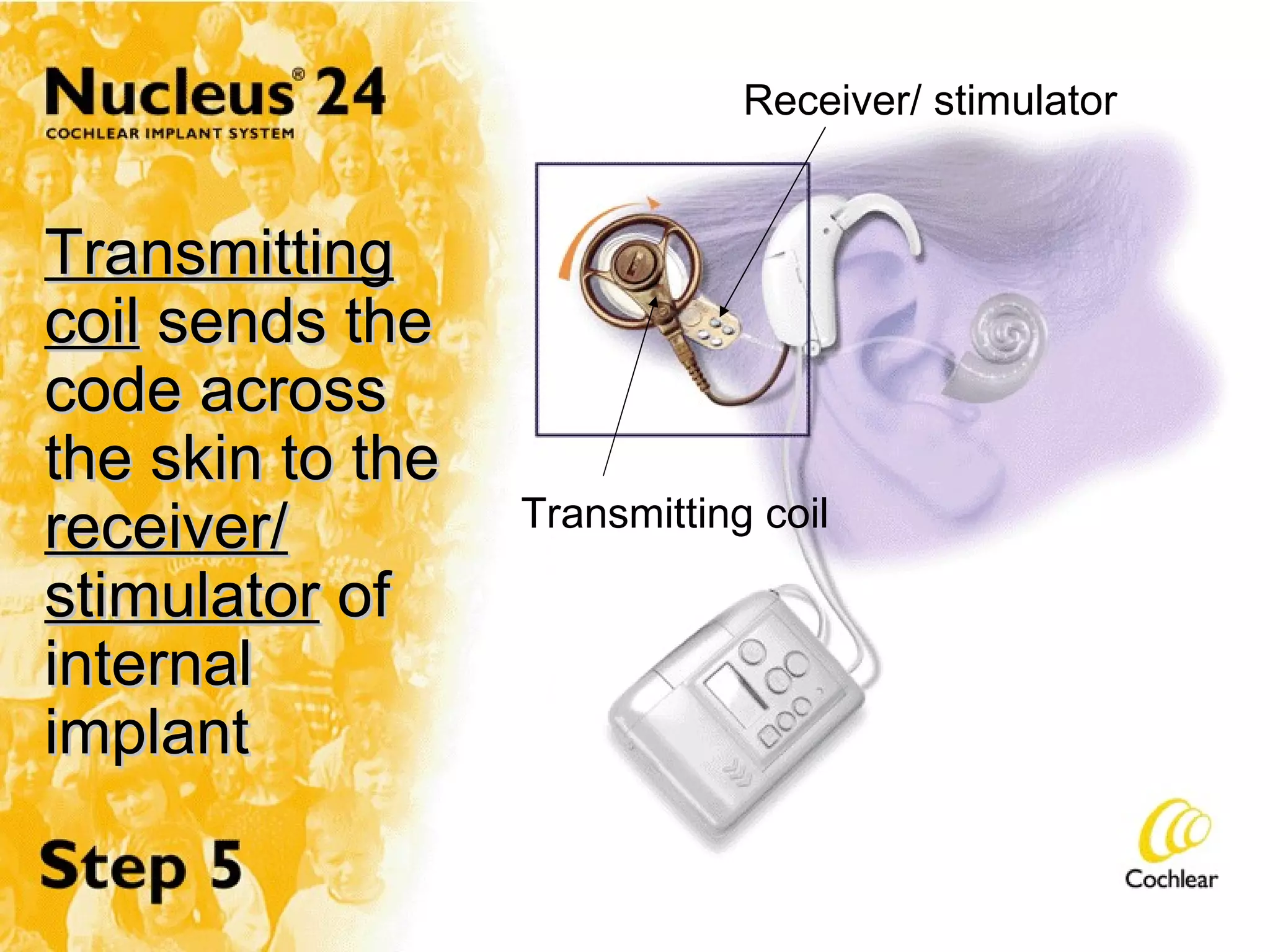 Cochlear Implant | PPS