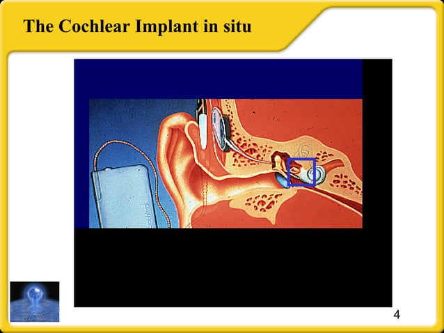 Cochlear Implant | PPS