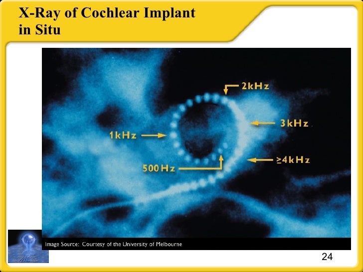 Cochlear Implant