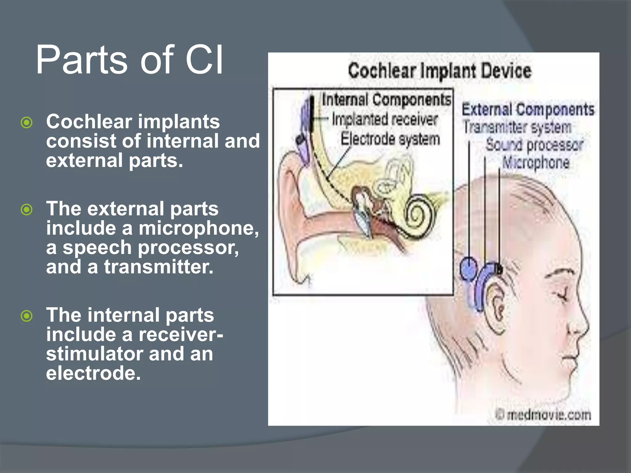 Cochlear implant | PPTX
