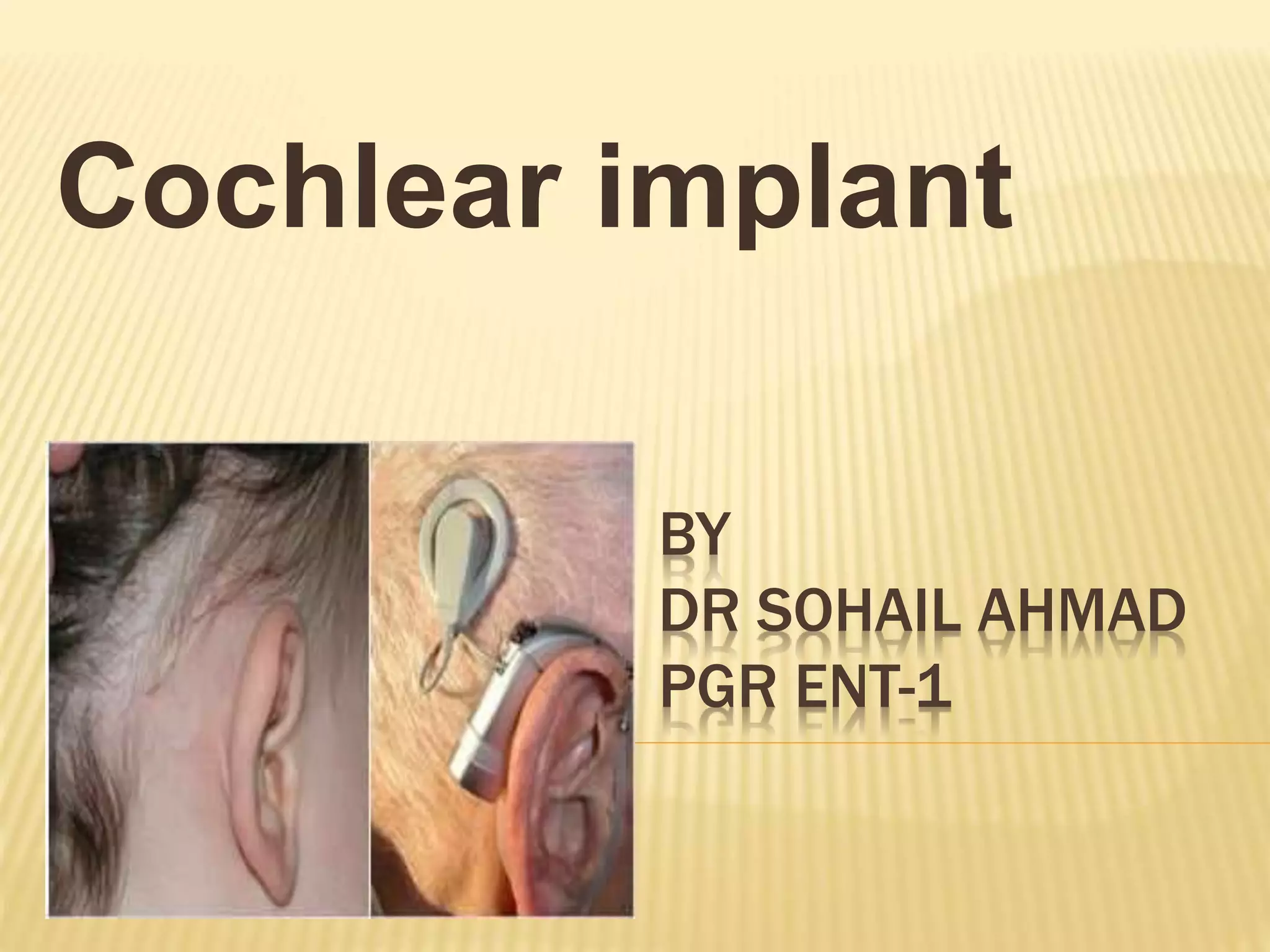 Cochlear Implantpptx Digital Audio Computer Software And Applications
