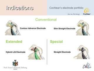 Cochlear Implant - 30 Years of Continuous Change: Monika Lehnhardt | PDF