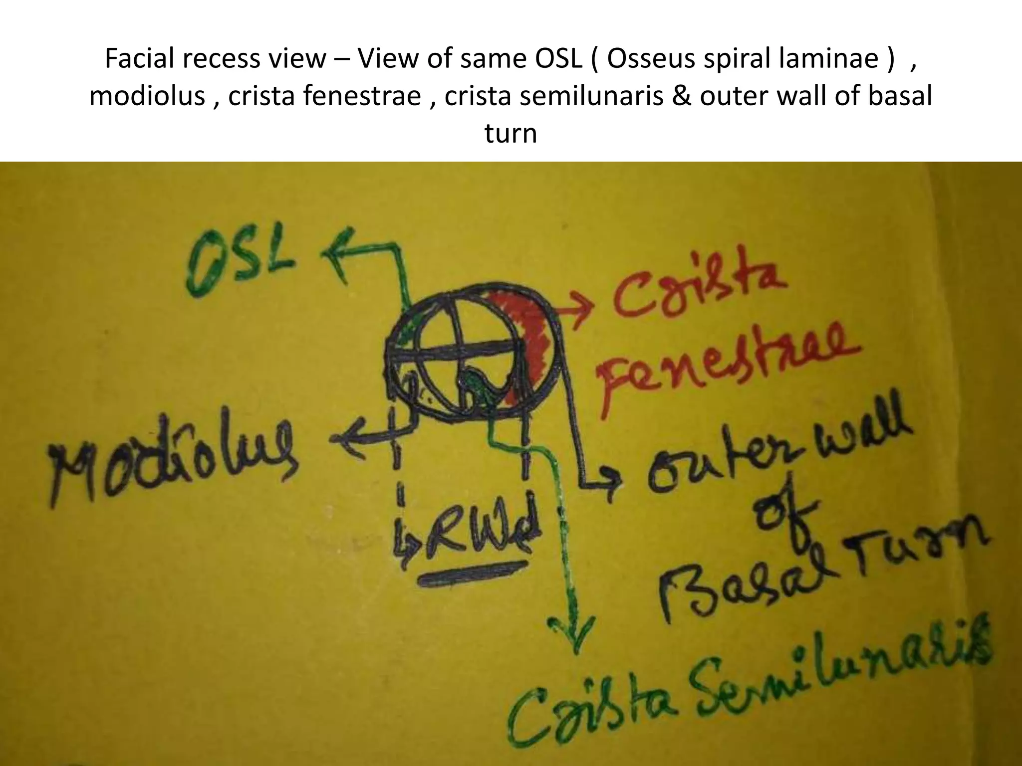 Cochlear implant - line diagrams | PPTX