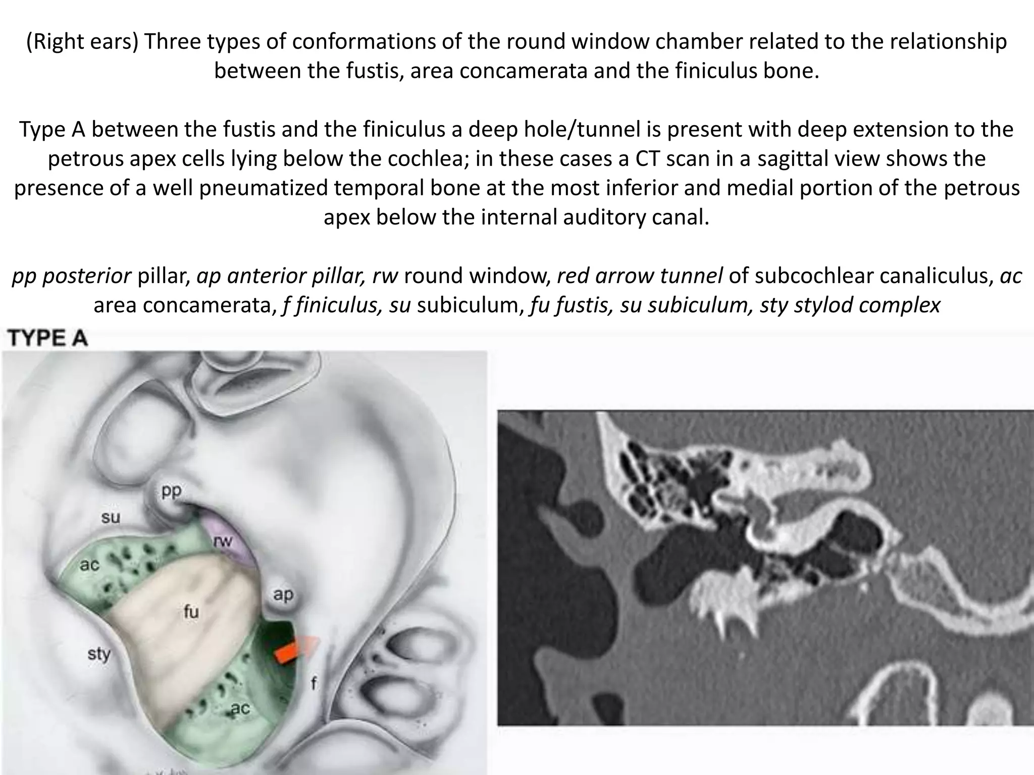 Cochlear implant - line diagrams | PPTX