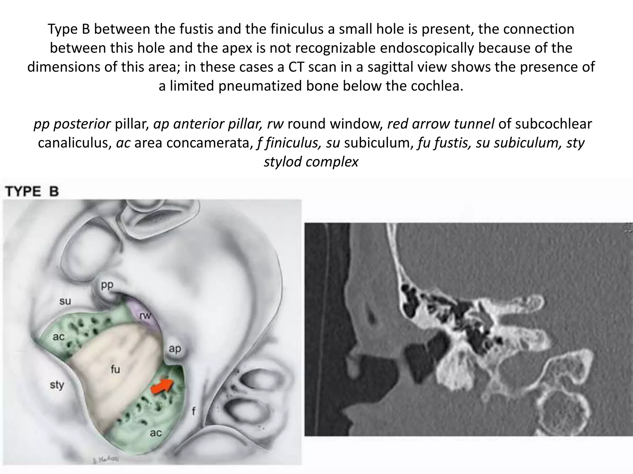 Cochlear implant - line diagrams | PPTX