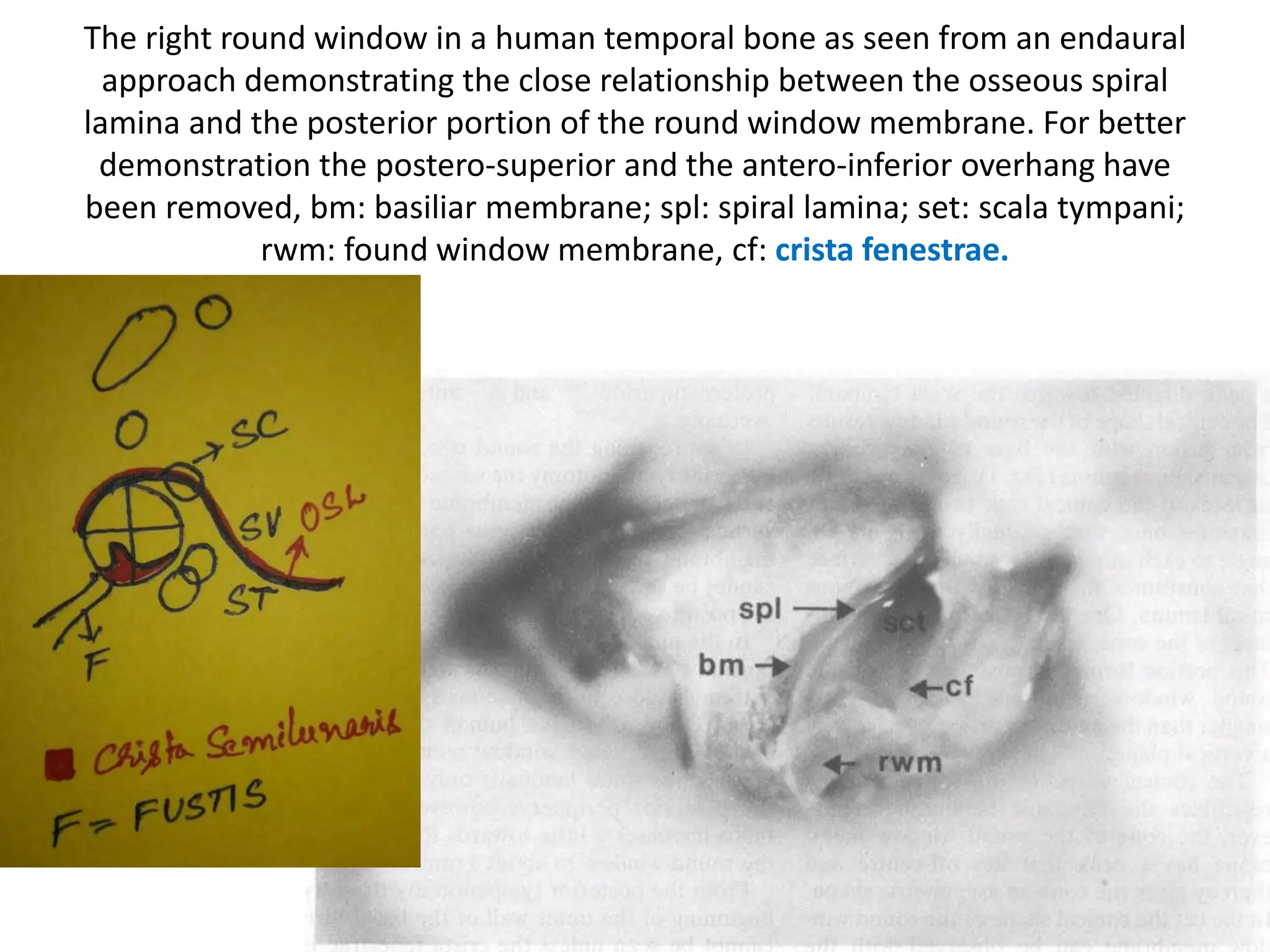 Cochlear implant - line diagrams | PPTX