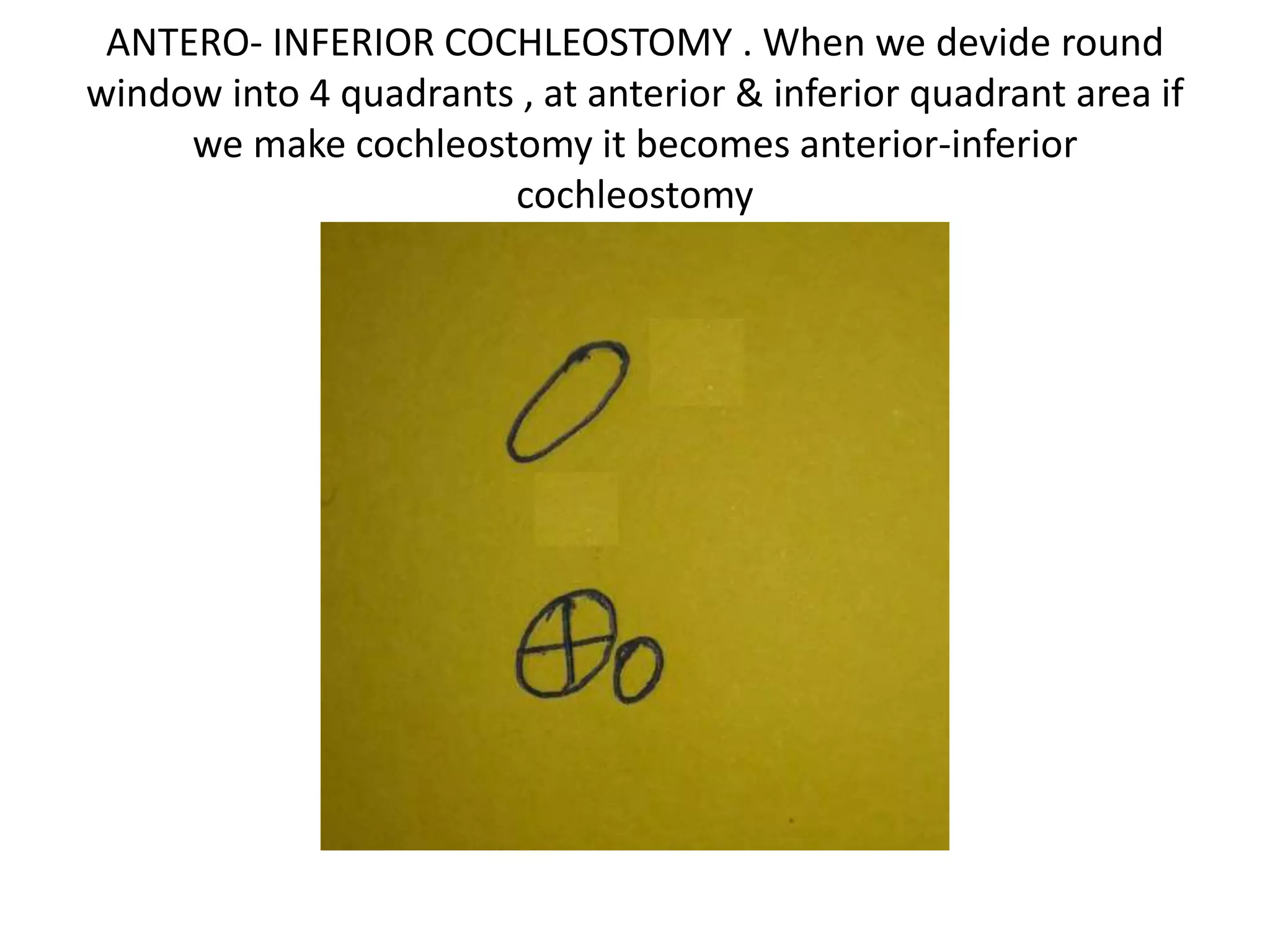 Cochlear implant - line diagrams | PPTX