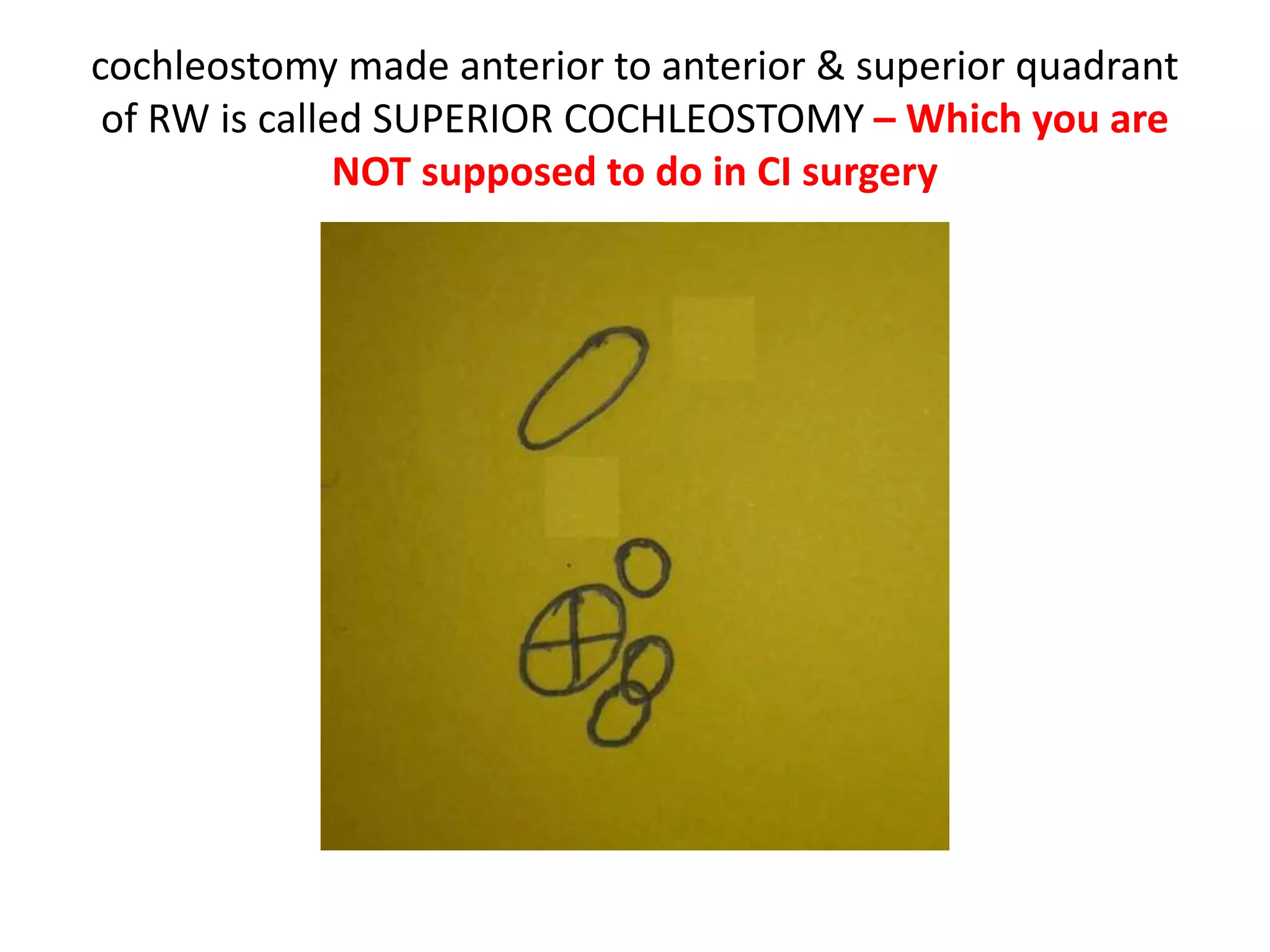 Cochlear implant - line diagrams | PPTX