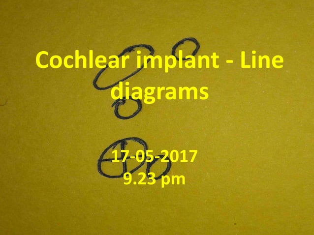 Cochlear implant - line diagrams | PPTX