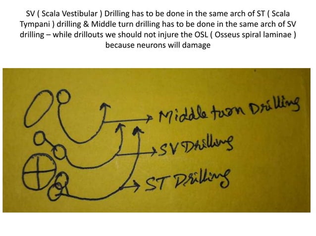 Cochlear implant - line diagrams | PPTX