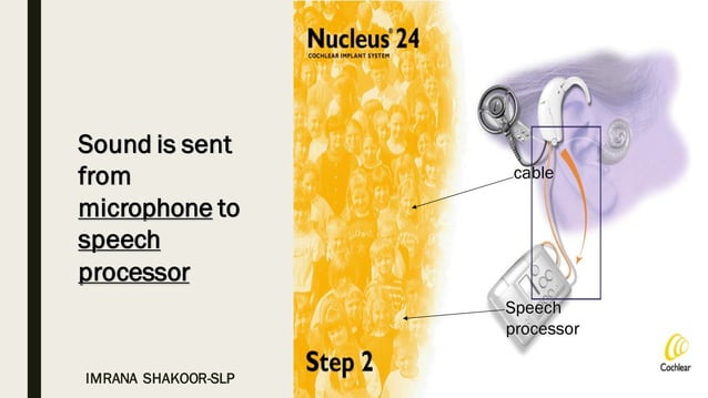 Cochlear Implant for deaf and hard of hearing | PDF | Digital Audio ...