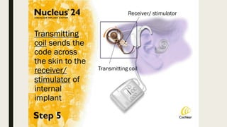 Cochlear Implant for deaf and hard of hearing | PDF | Digital Audio ...