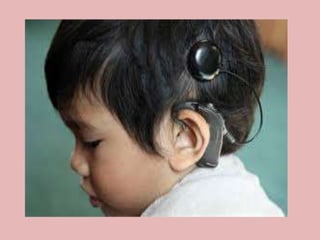 cochlear implant [Autosaved].pptx
